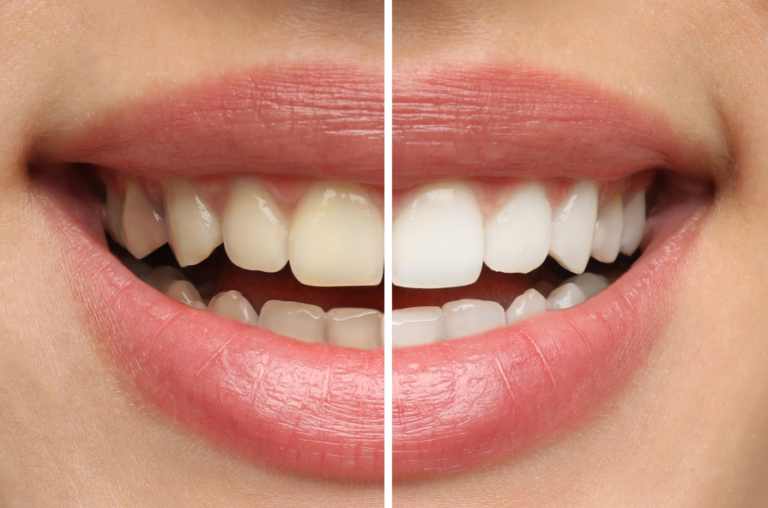 Store-Bought vs. Professional: Not All Whitening Kits Are Created Equal ...